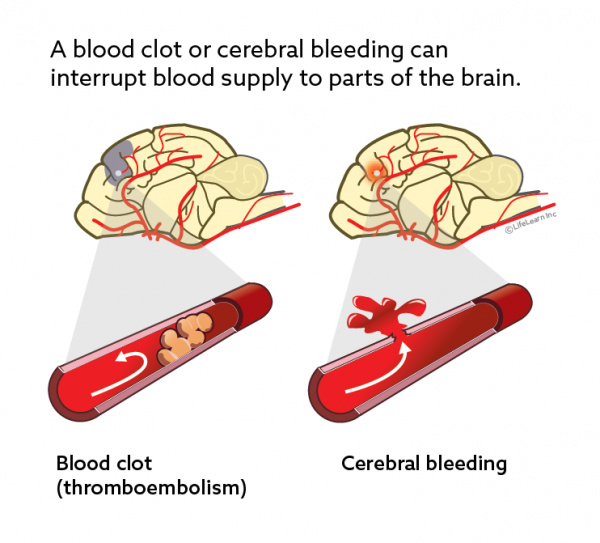 Strokes in Cats | VCA Animal Hospital